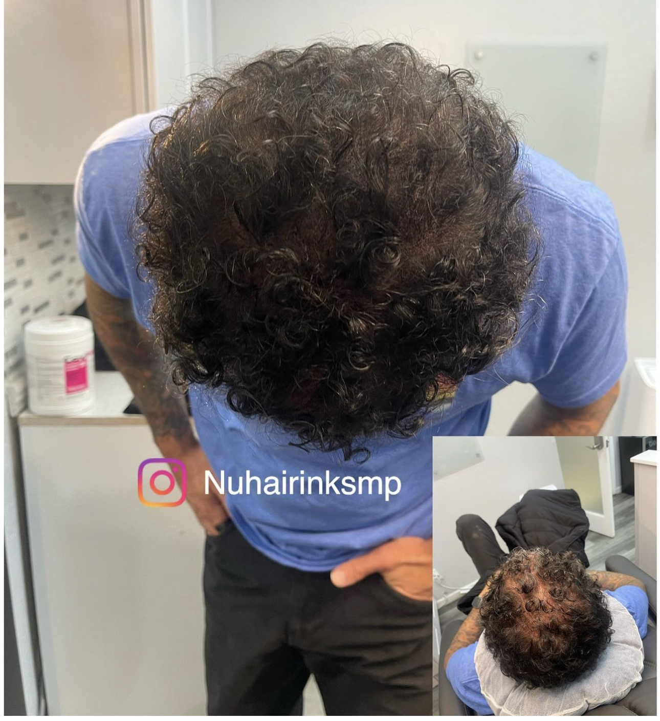 Nuhair Ink | Scalp Micro Pigmentation | Permanent Hair Loss Solution