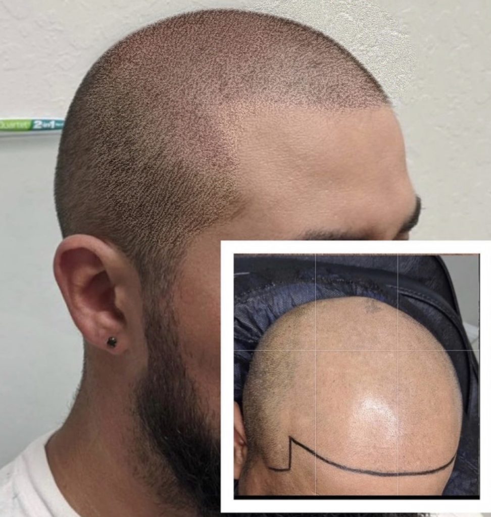 Nuhair Ink | Scalp Micro Pigmentation | Permanent Hair Loss Solution