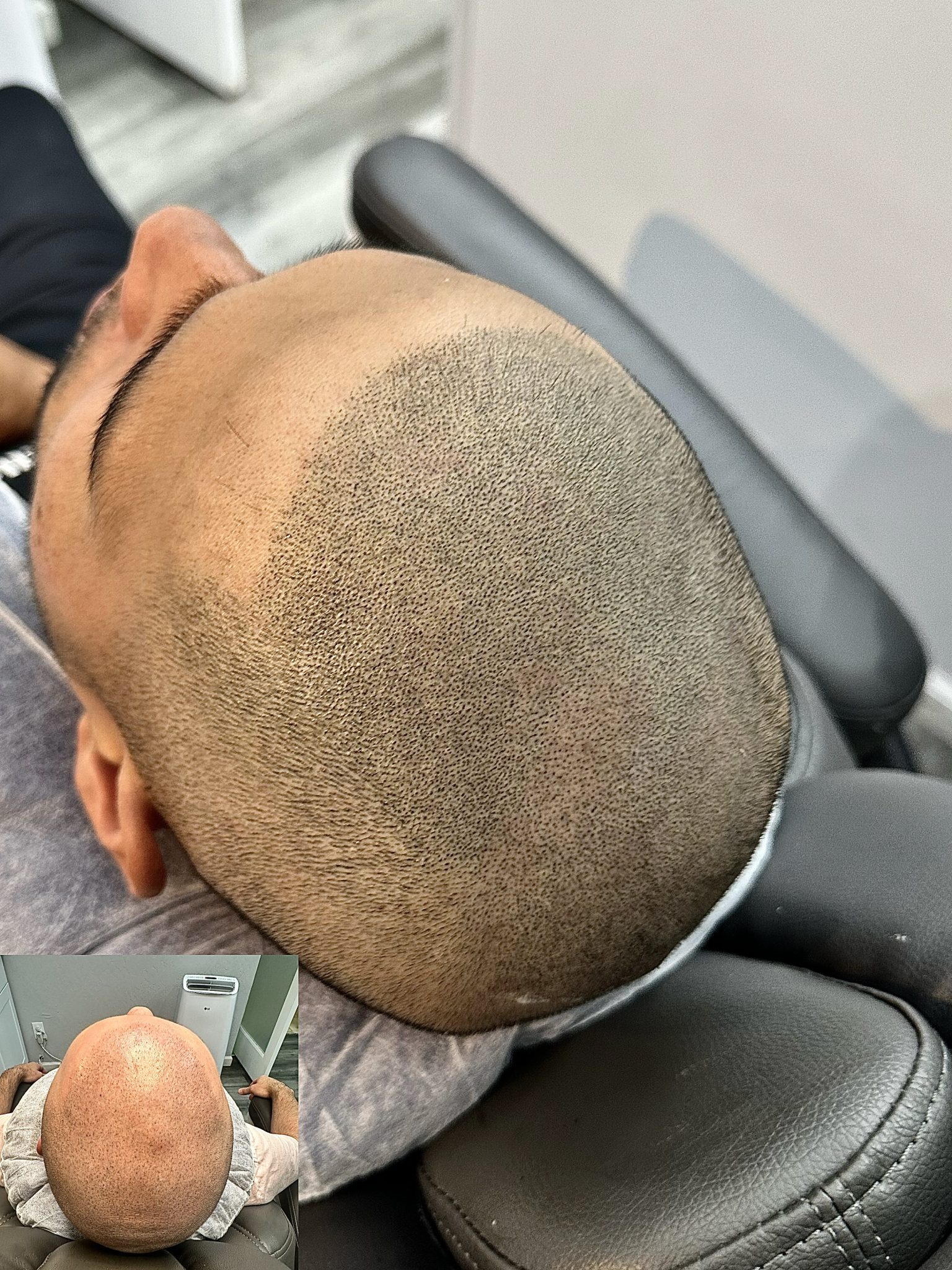 Nuhair Ink | Scalp Micro Pigmentation | Permanent Hair Loss Solution
